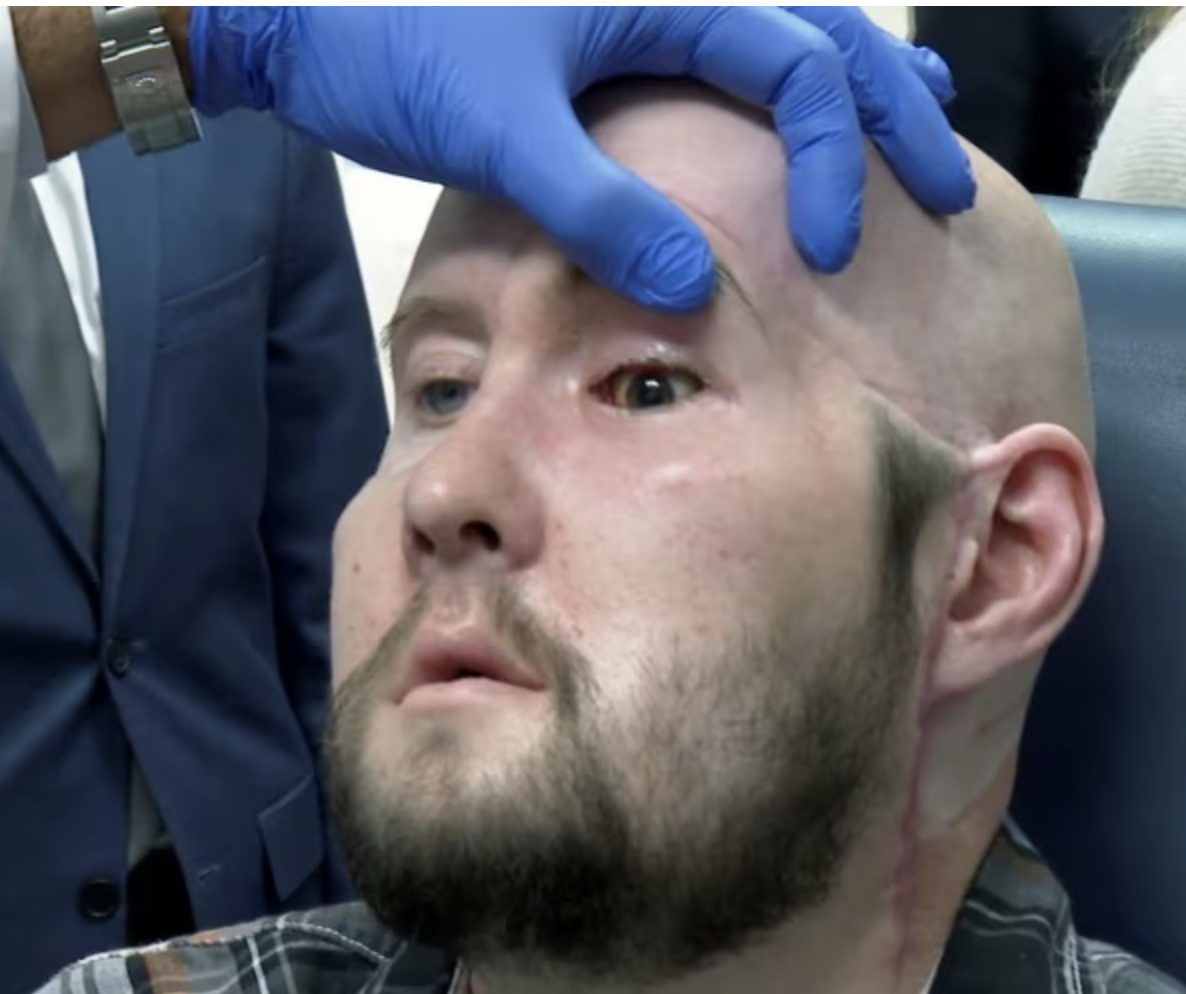 Man receives the first eye transplant, new face - IEyeNews
